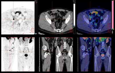 PSMA PET CT Imaging | MIC Medical Imaging
