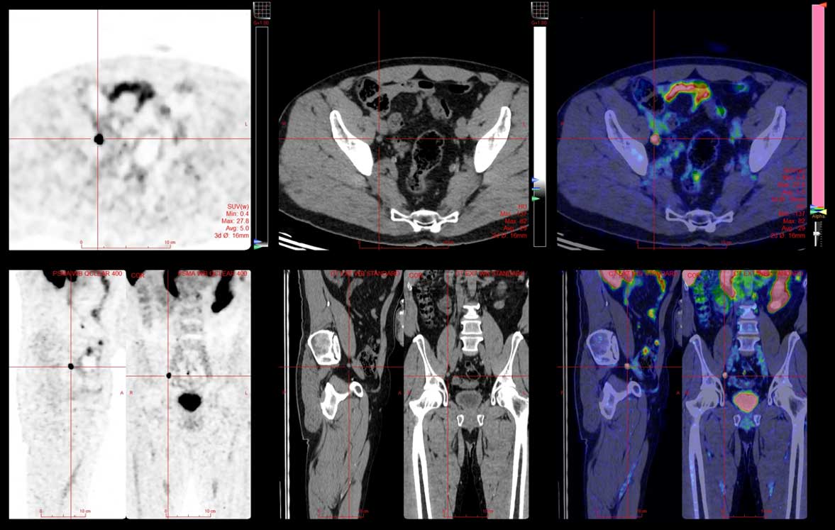 PSMA PET CT Imaging | MIC Medical Imaging