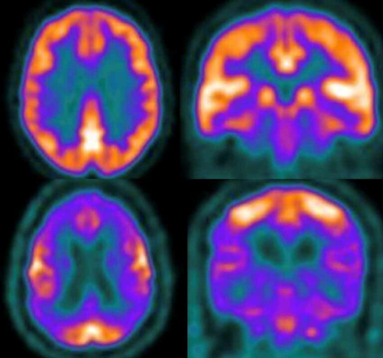 FDG PET CT Imaging | MIC Medical Imaging