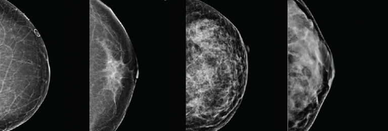 Breast Ultrasound In Edmonton | ABUS & HHUS | MIC Medical Imaging